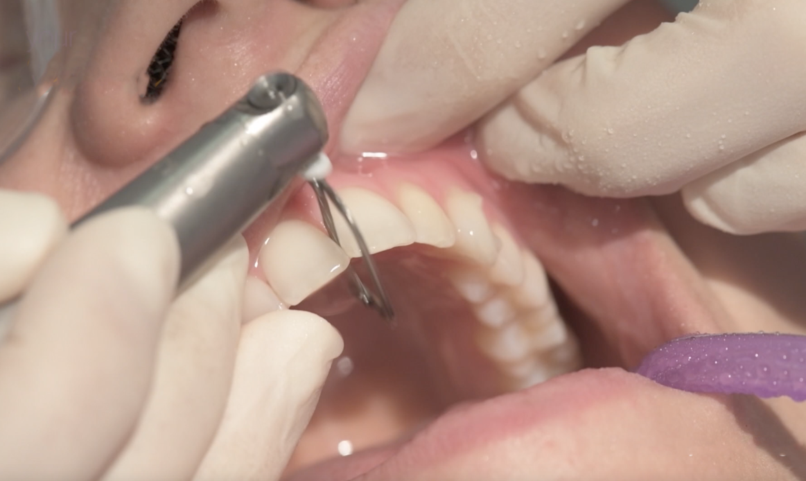Effective application of interproximal reduction during aligner treatment