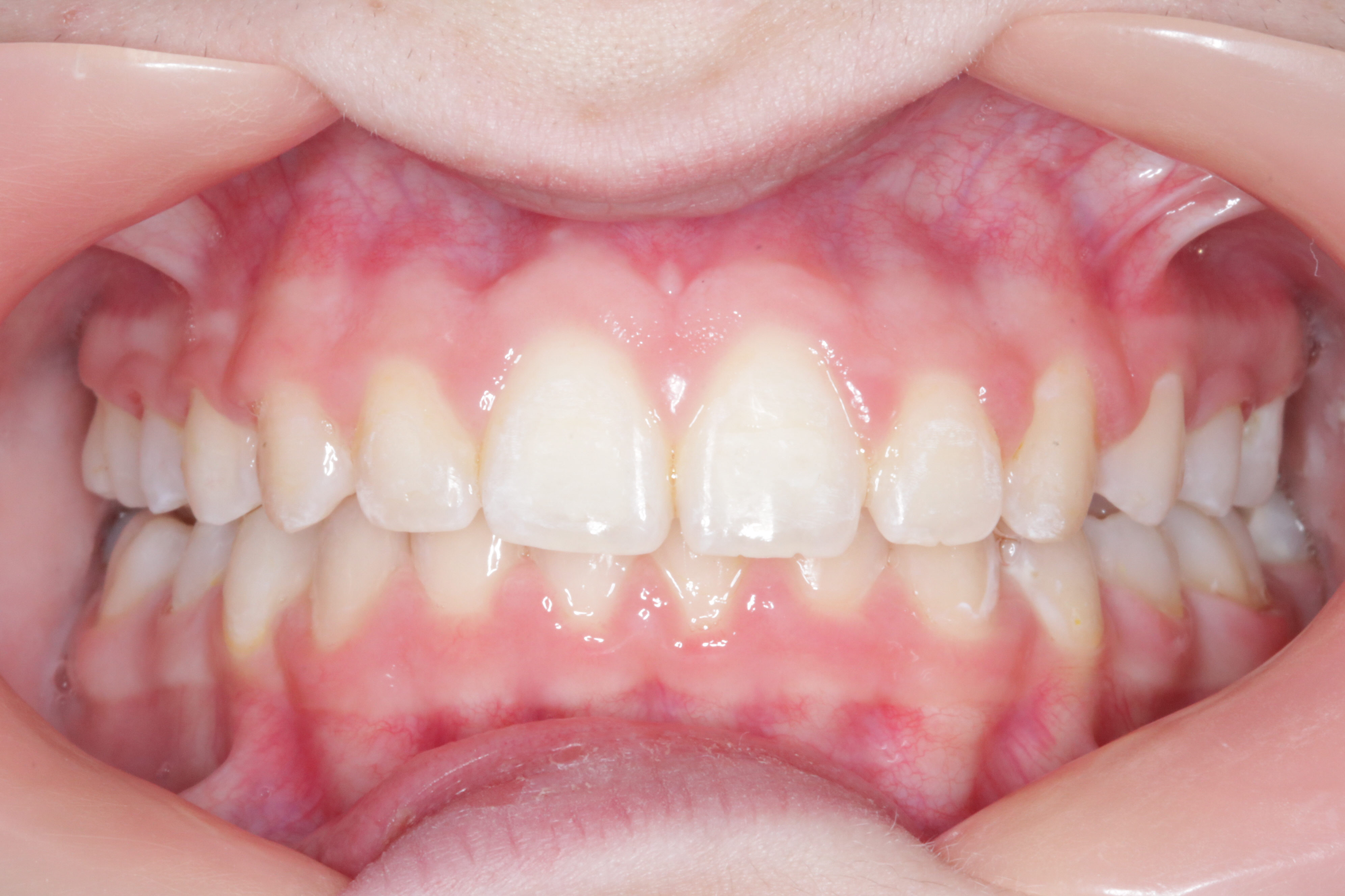 Dental News - Boosting facial aesthetics through a hybrid approach of ...