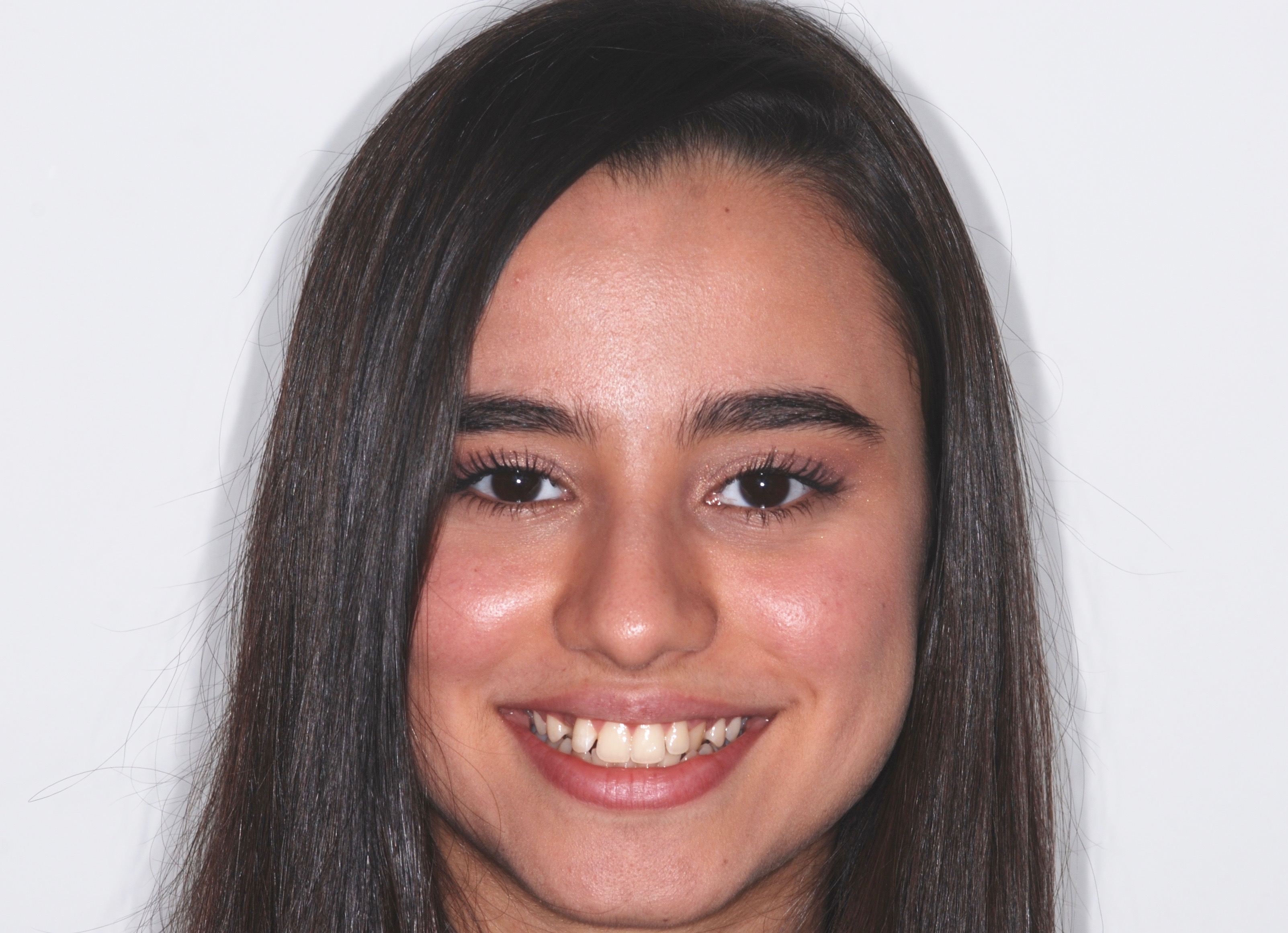 Dental News - Streamlining clear aligner therapy–Success without ...