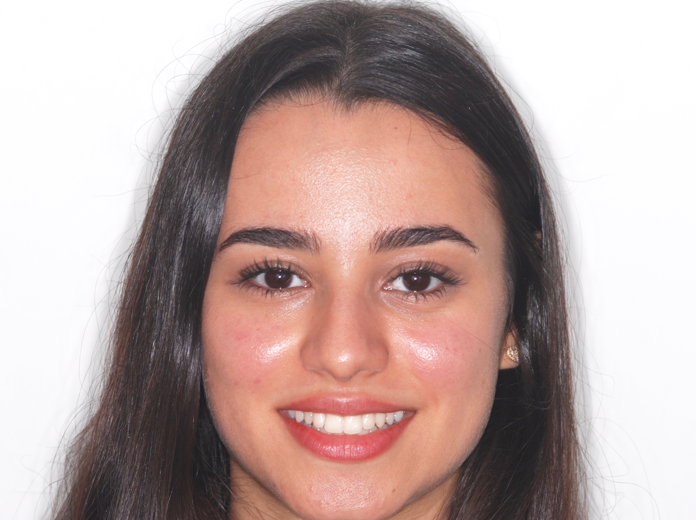 Dental News - Streamlining clear aligner therapy–Success without ...