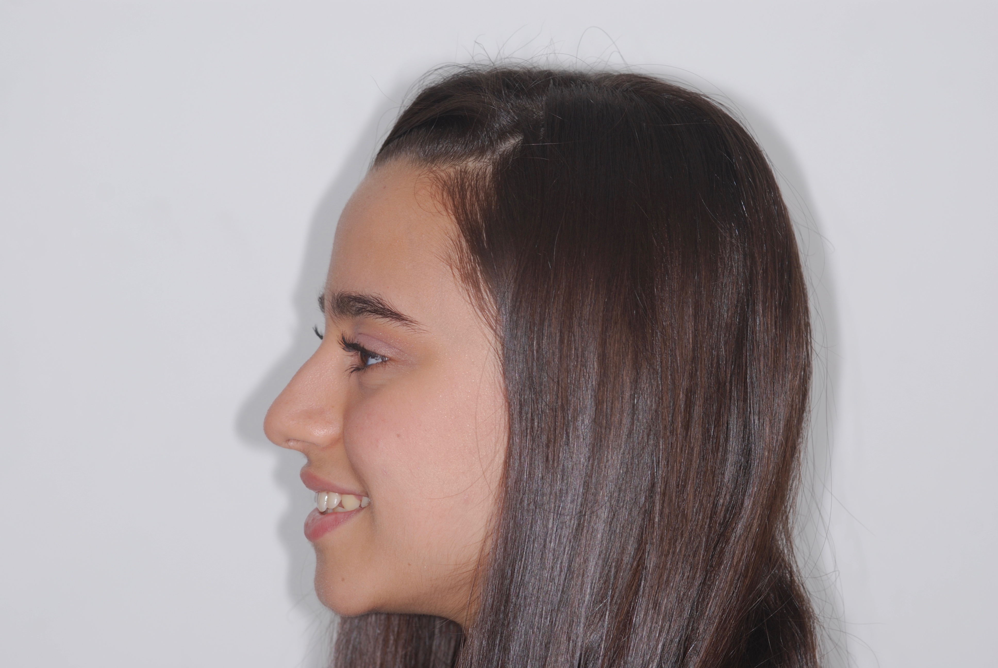 Dental News - Streamlining clear aligner therapy–Success without ...
